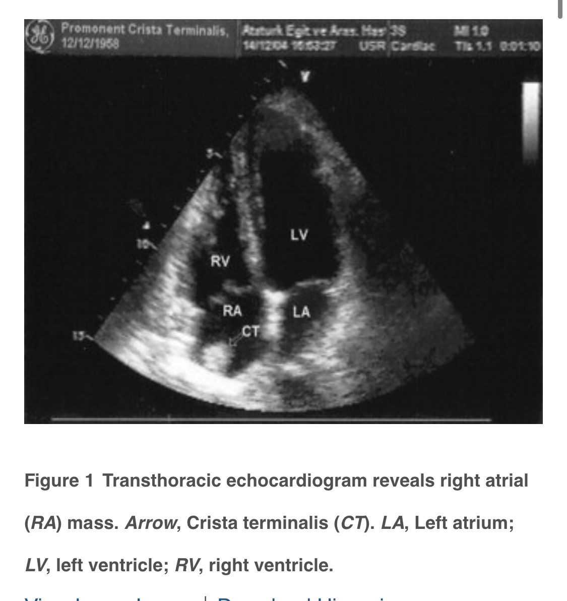 Crista Terminalis Echo Cor Triatriatum Sinister And Giant Eustachian