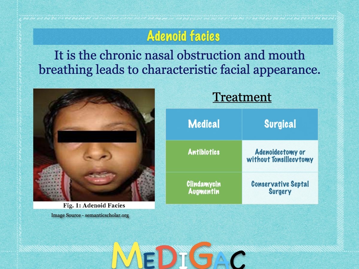 Adenoid Facies Features