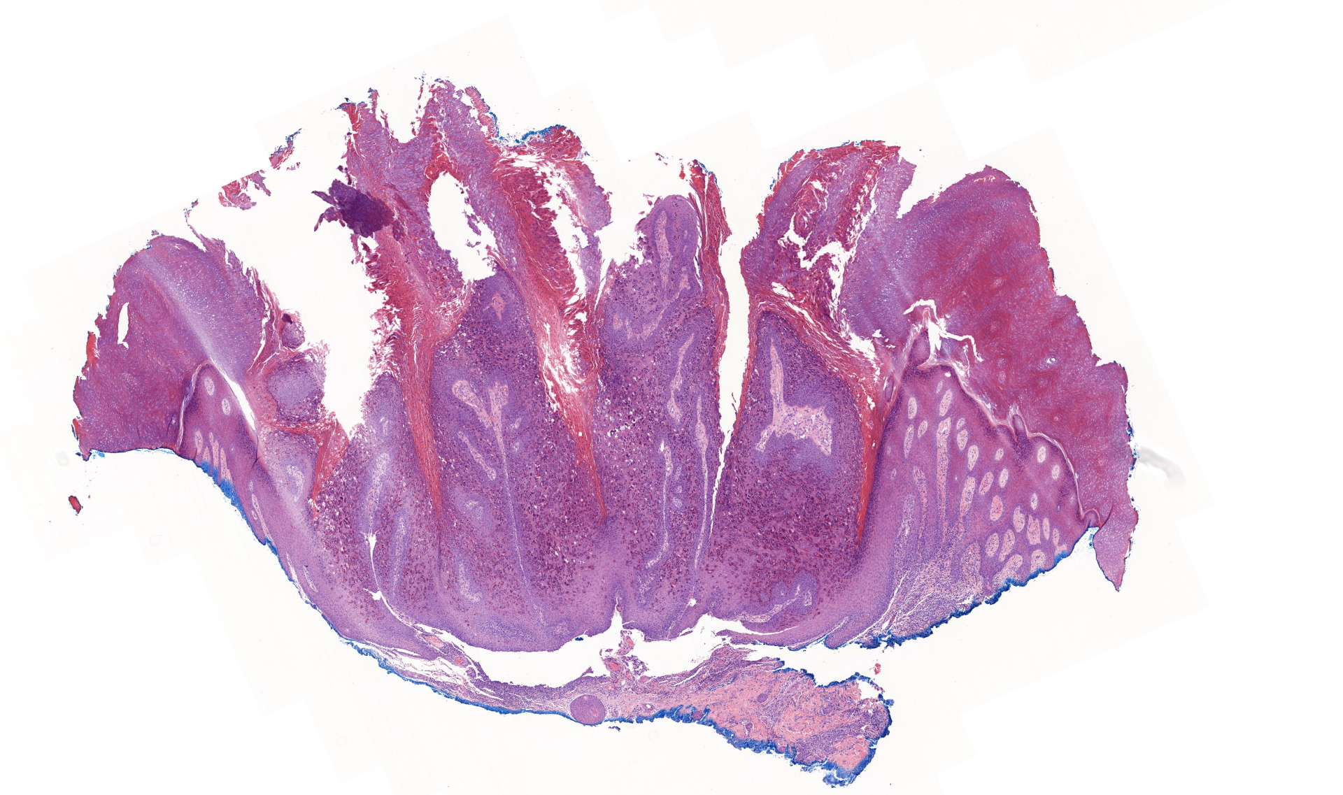 Verruca Vulgaris Histology A Rare Case Of Large, Unusual, And