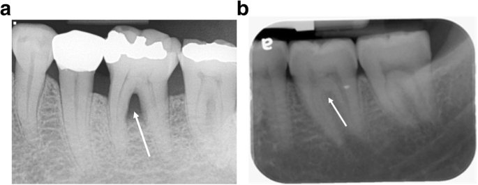 Interradicular Bone