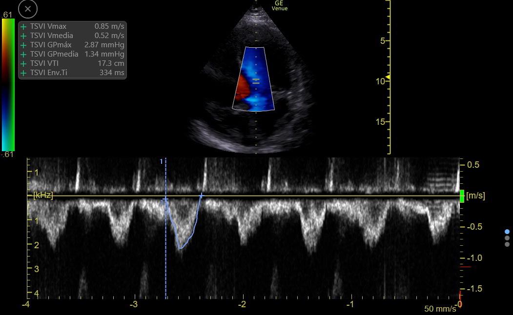 #Hemodynamics Case: Young patient with SLE comes with acute dyspnea. BP ...