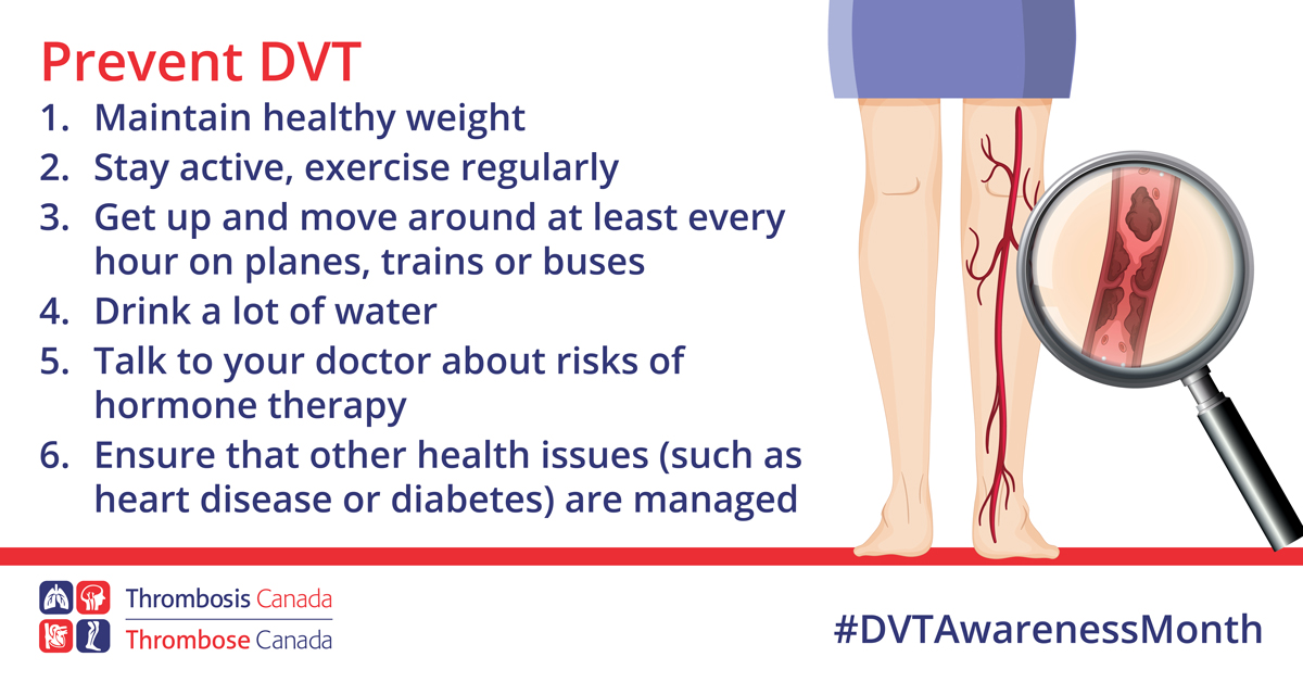 Exercises To Prevent Dvts