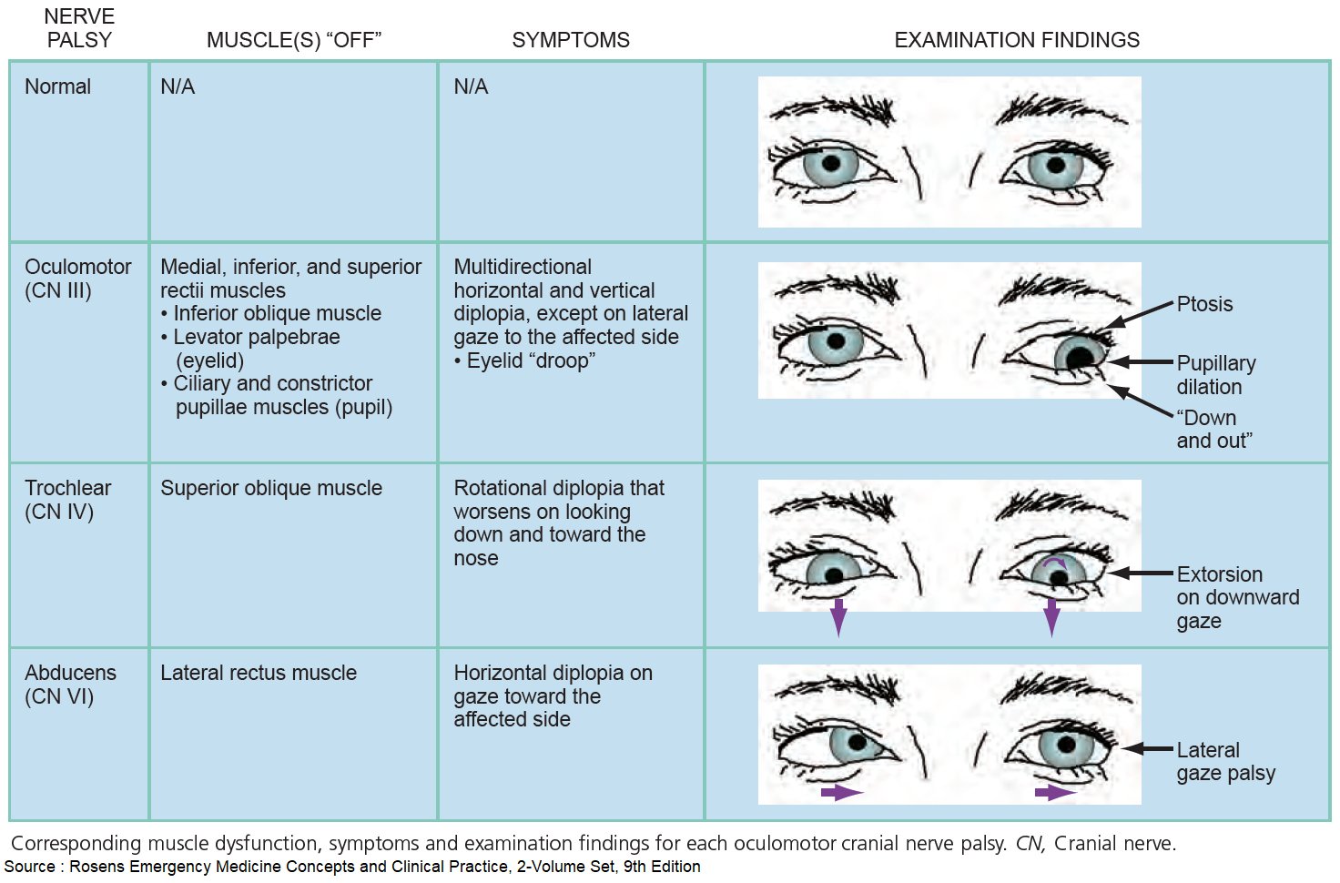 Cranial Nerve Palsy – CN III, IV, VI VII Palsy, 53% OFF Cranial Nerve Palsy – CN III, IV, VI VII Palsy, 53% OFF