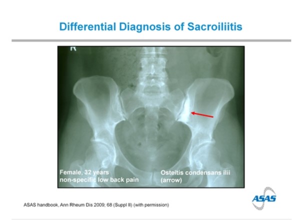 Osteitis Condensans Ilii Radiology Bits En X: "Answer Quiz178:osteitis