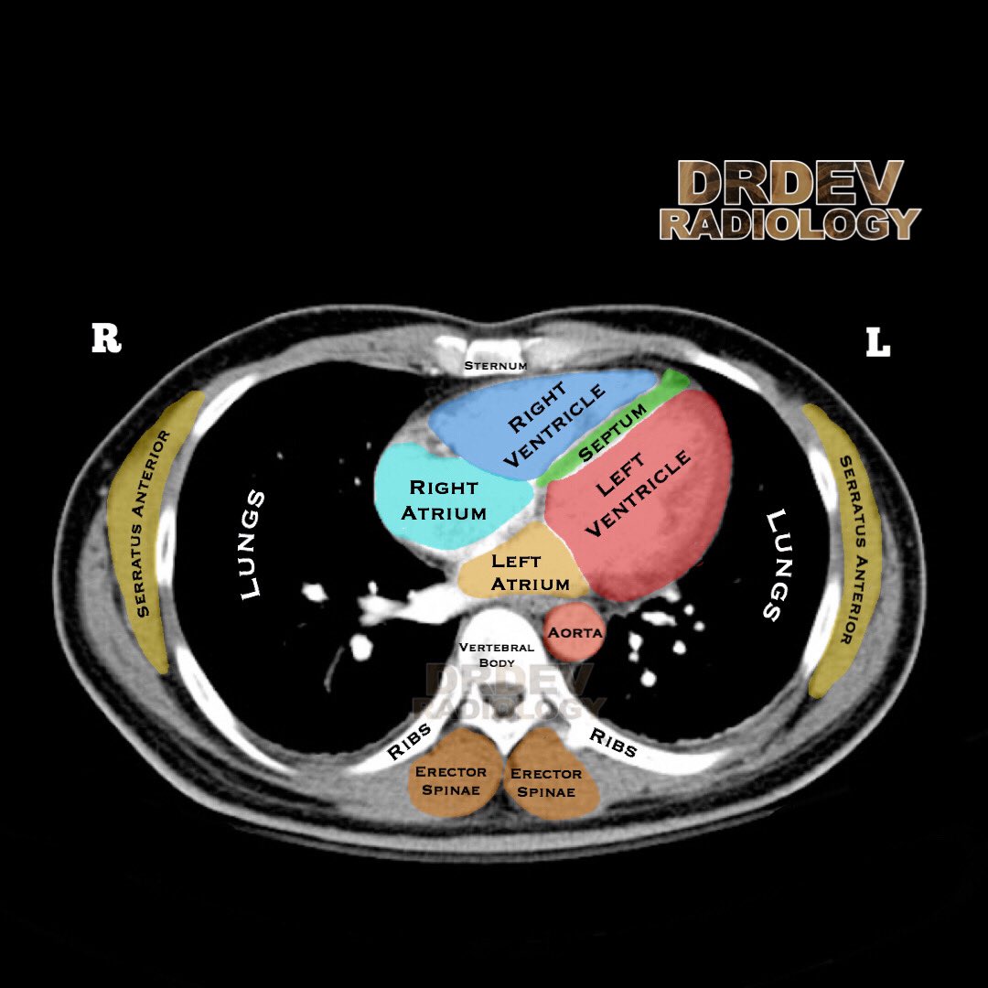 Annotated anatomy of the CT Thorax from that time in residency when I ...