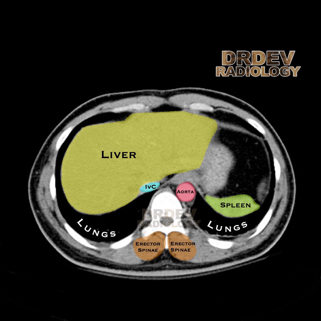 Annotated anatomy of the CT Thorax from that time in residency when I ...