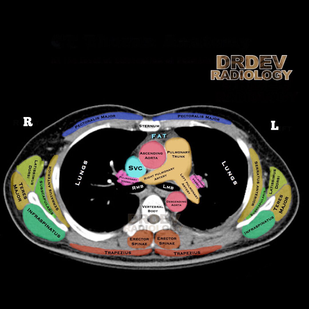 Annotated anatomy of the CT Thorax from that time in residency when I decided that this was the ...