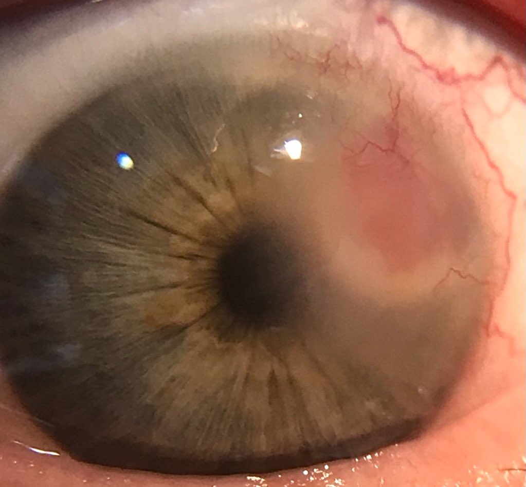 Stromal Keratitis