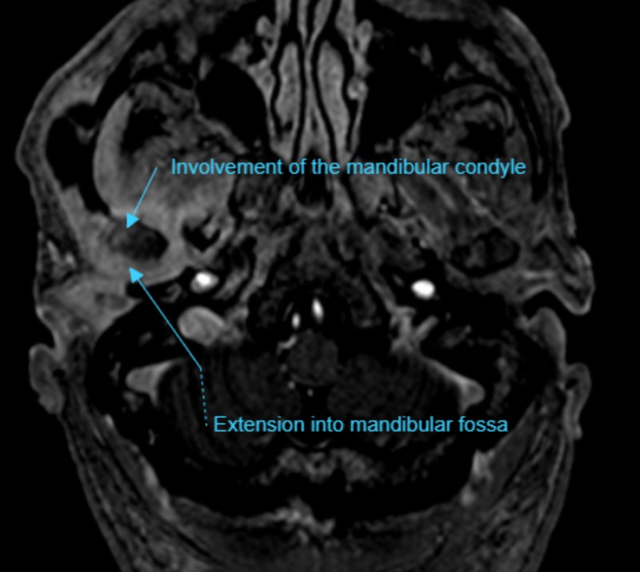Malignant Otitis Externa Mri