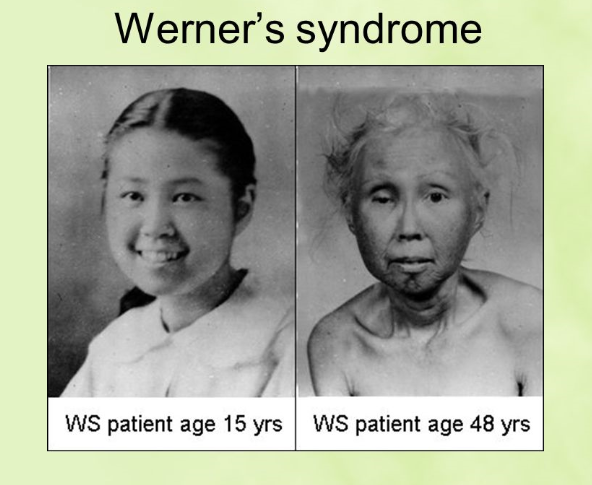Werner Syndrome Progeria Adult 15 Fascinating Facts About Progeria,