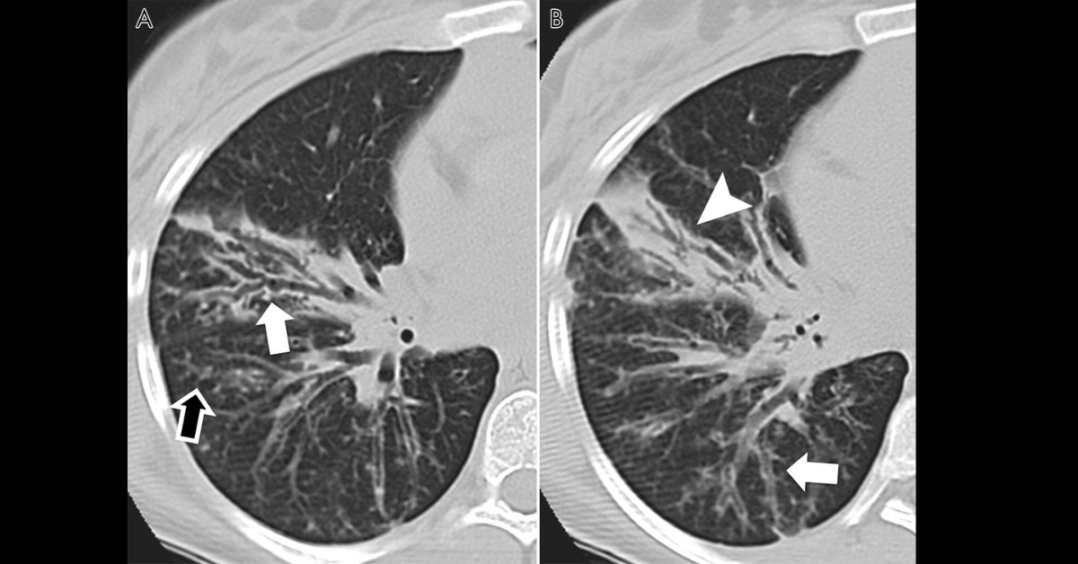 Tram Tracks Lungs