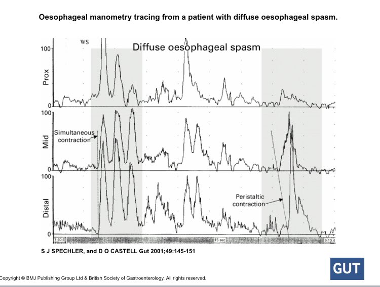 Diffuse Esophageal Spasm Manometry