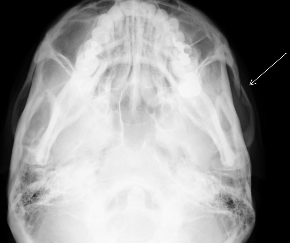 Submentovertical Zygomatic Arches
