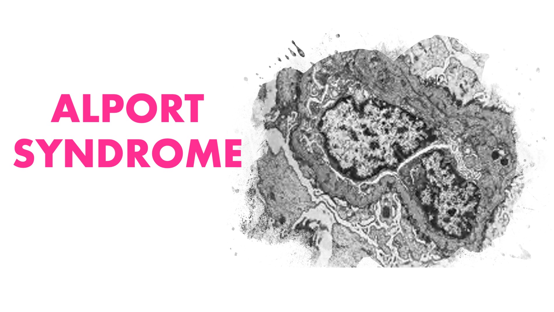 Alport Syndrome Basket Weave