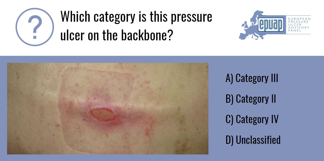 Pressure Ulcer Staging Quiz