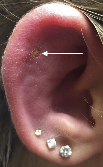 Abscess Ear Lobe