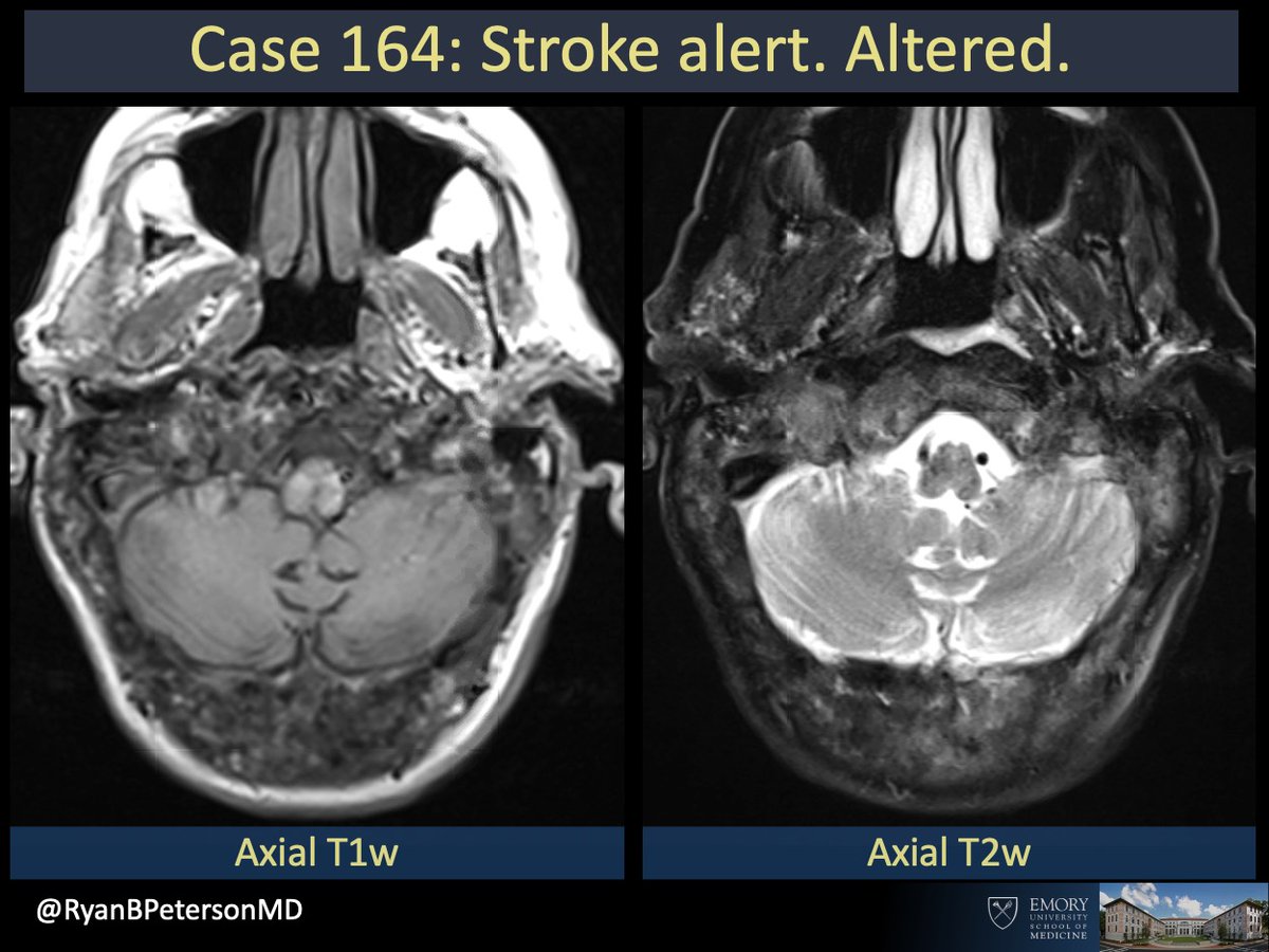 Emory Radiology COTD #164 Hx: Stroke alert. Altered mental status NO ...