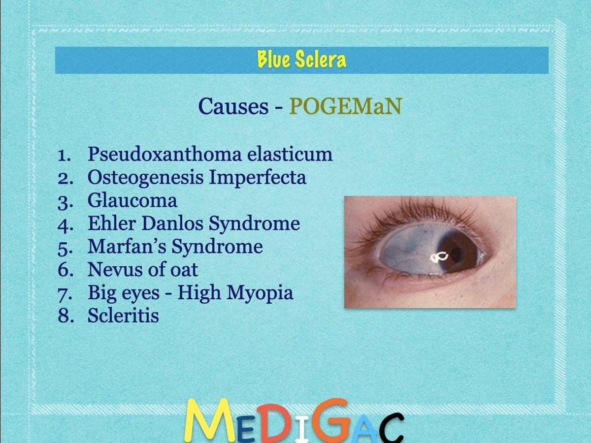 Osteogenesis Imperfecta Blue Sclera Bilateral Papilledema In A Child
