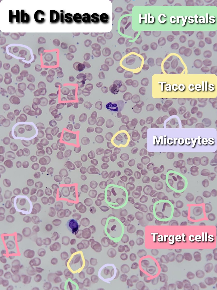 Hemoglobin C Crystals