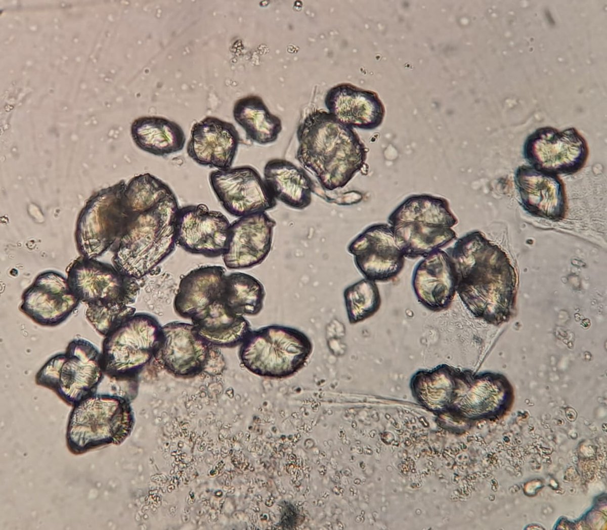 Starch Granules In Urine