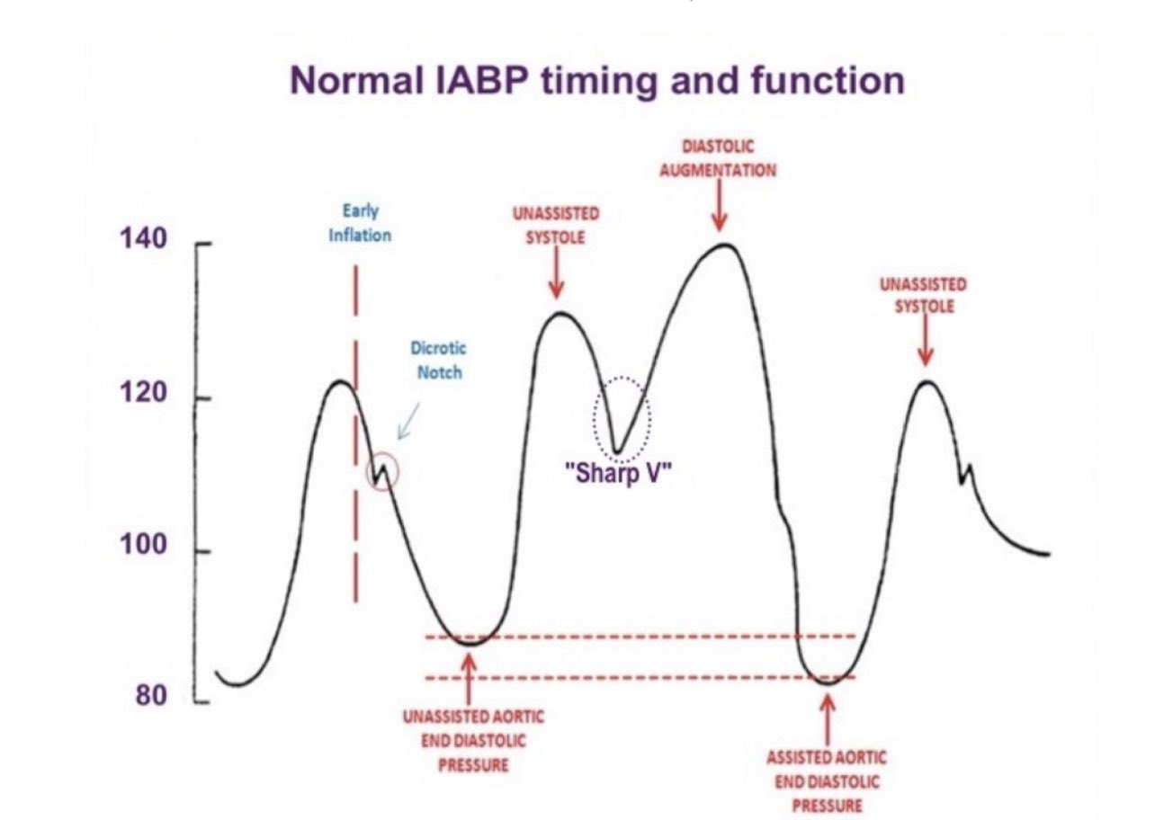 Deep Y-Descent In Right Atrial Waveforms Following Left, 40% OFF Deep Y-Descent In Right Atrial Waveforms Following Left, 40% OFF