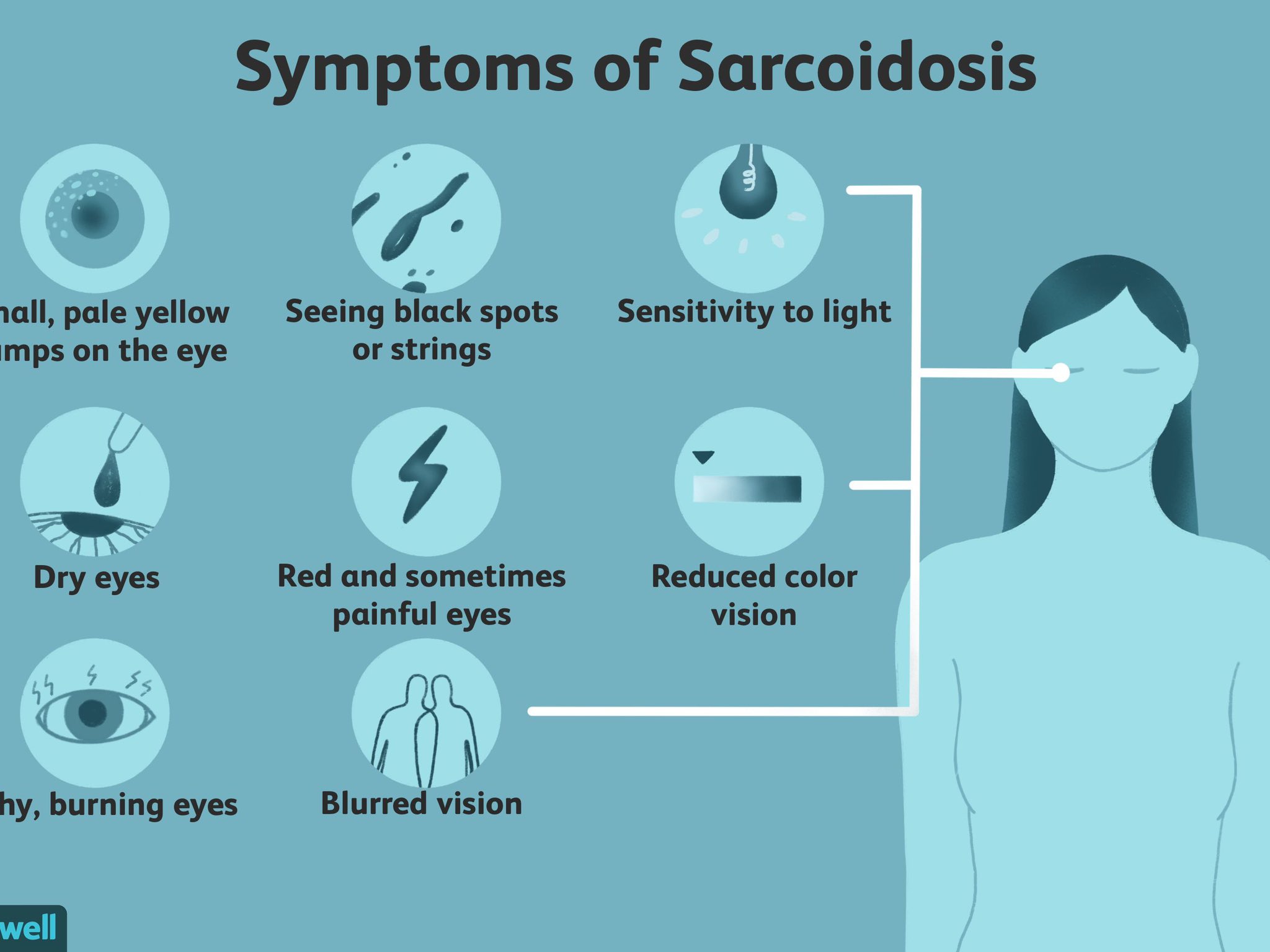 Sarcoidosis Eye