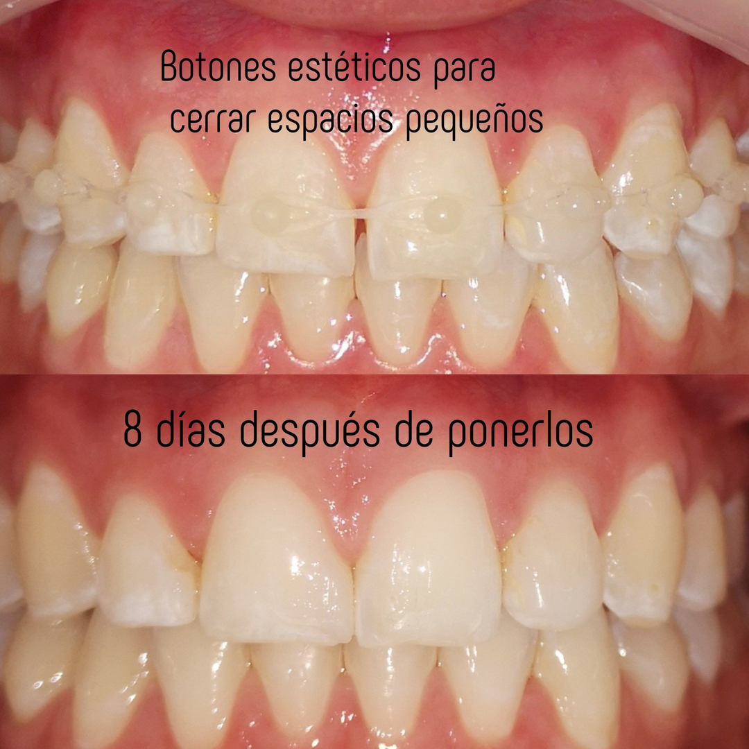 escucha Por ley seno botones esteticos ortodoncia Consejo Atrevimiento ...