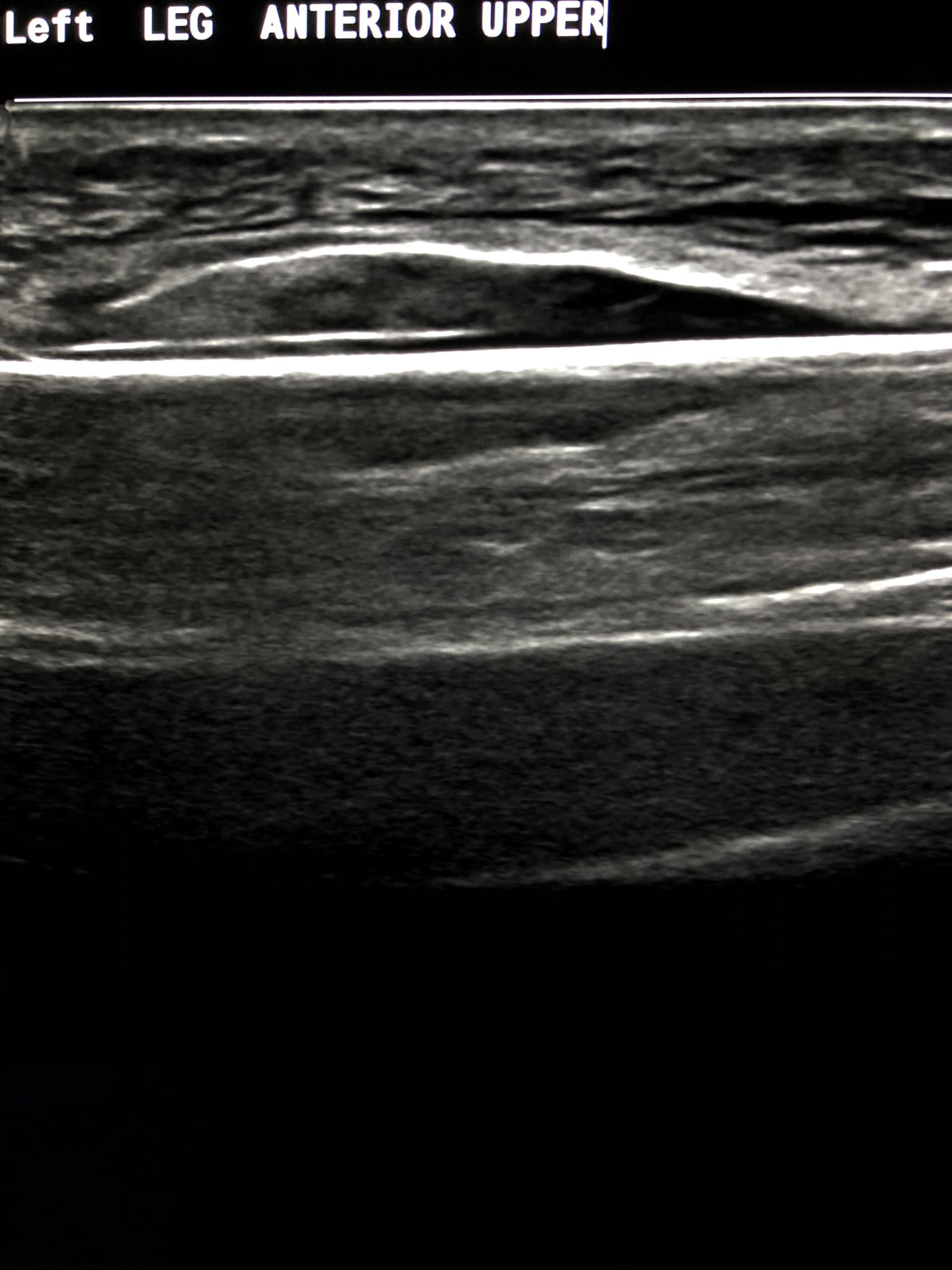 Subperiosteal Hematoma