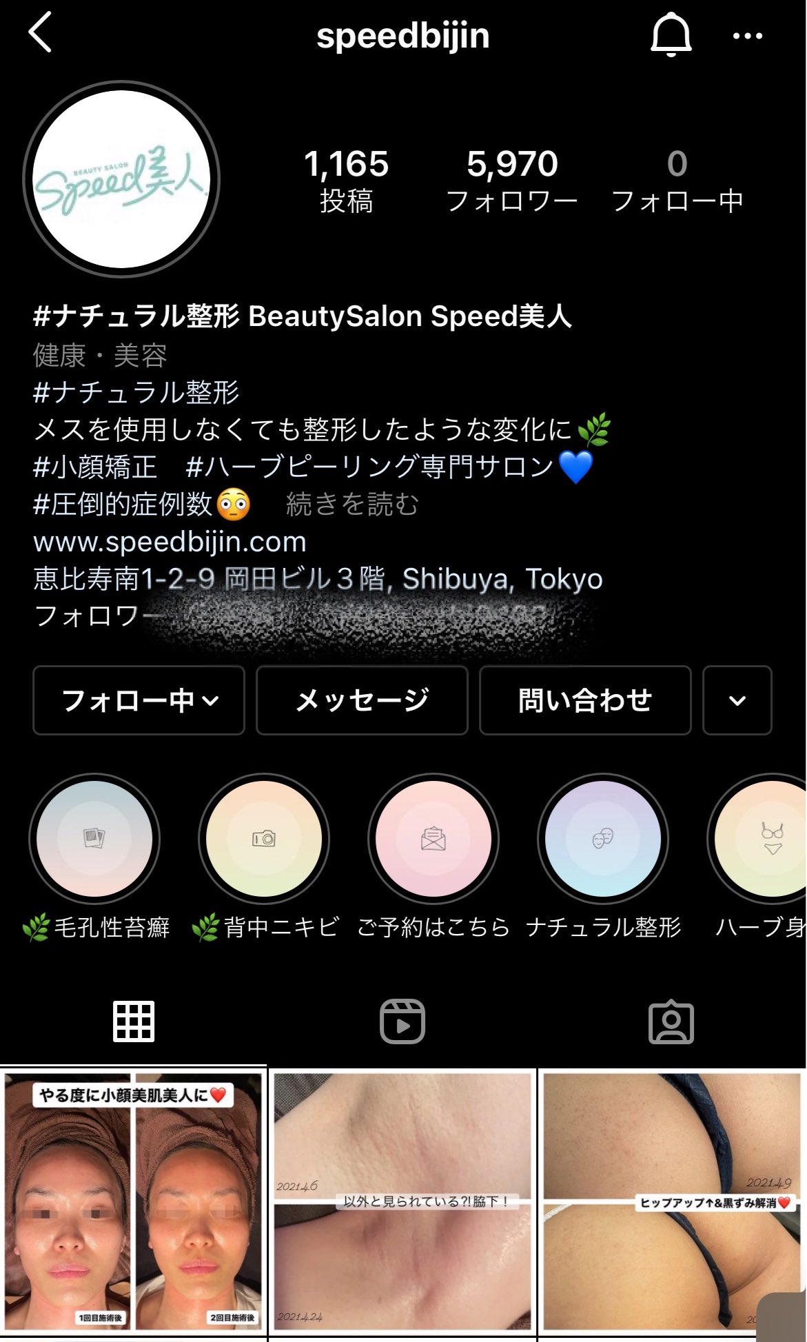 雅ちゃん(手術日未定) on Twitter: "ハーブピーリングは好きなYouTuberのUchanさんが小顔矯正で行ってた恵比寿のspeed美人に通ってて、かなり良い。クレーターやニキビ跡 ...