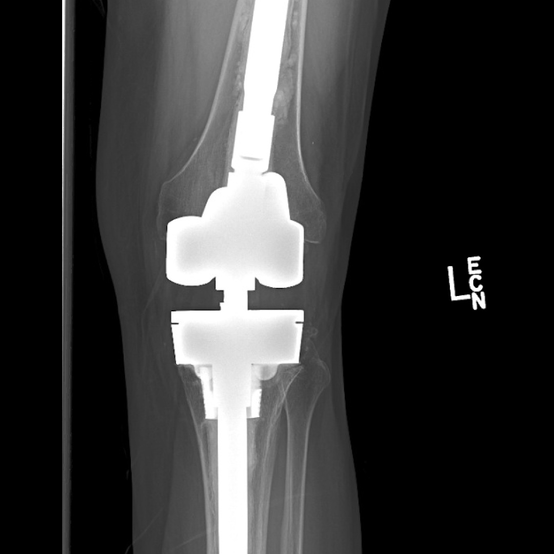 Hinged Knee Revision X Ray