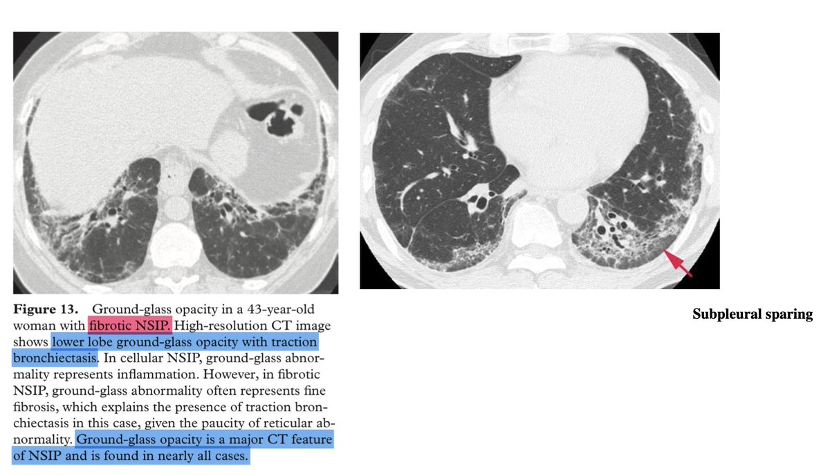 A 🧵with info on idiopathic ILDs! @KirtanPatolia @AnnKumfer @k_vaishnani ...