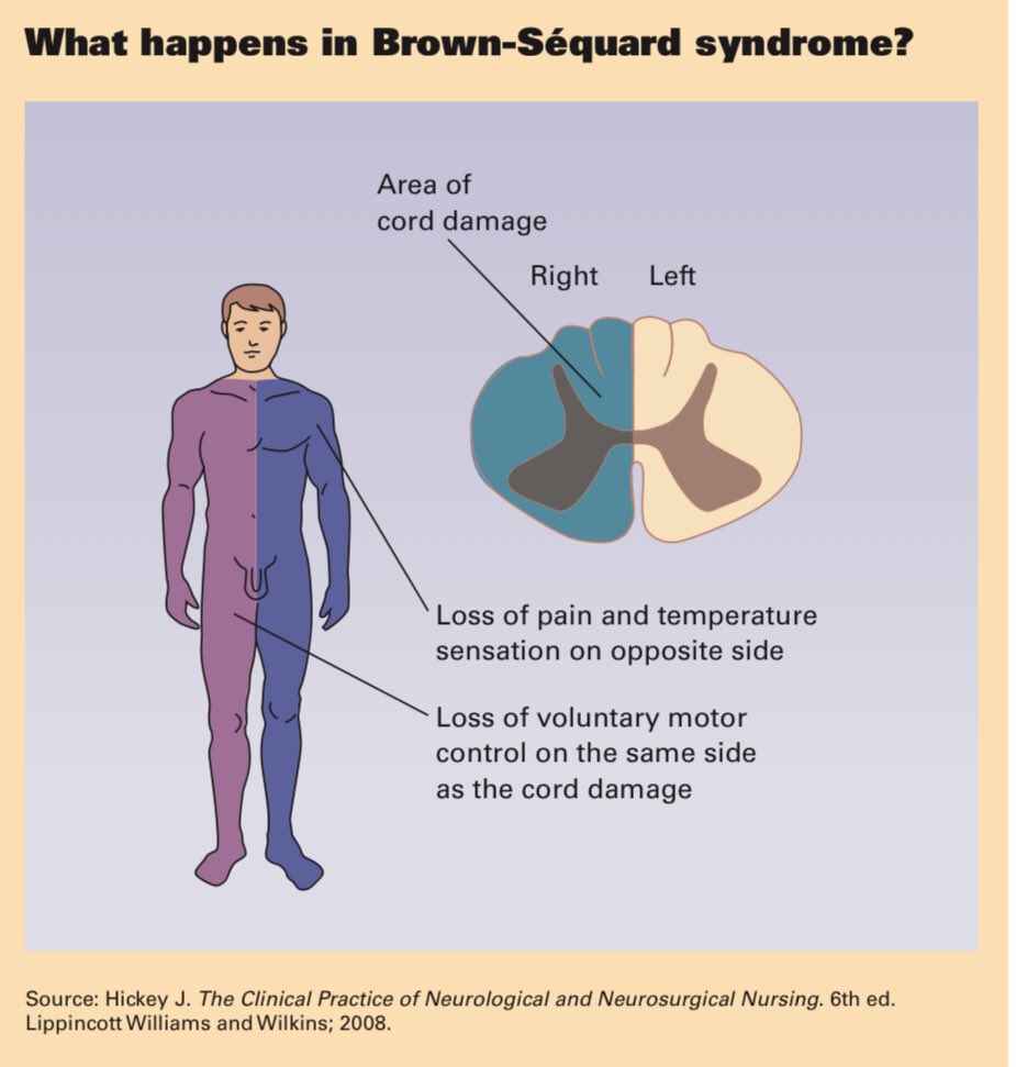 Brown Sequard Syndrome Mnemonic