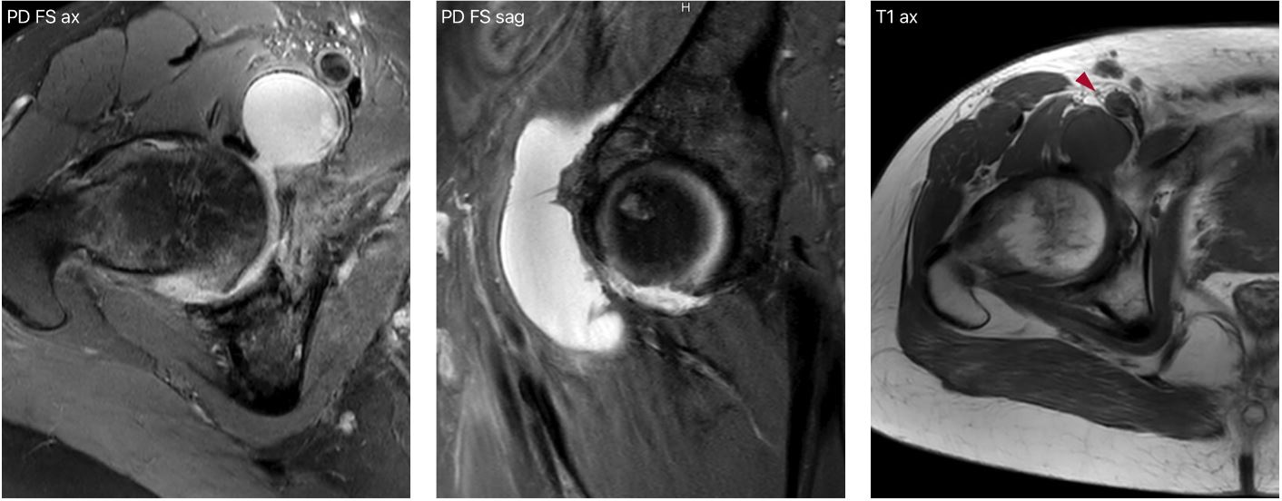 Iliopsoas Bursitis Mri Iliopsoas Muscles Injuries | Musculoskeletal