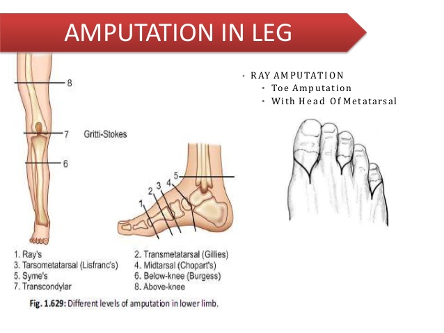 Tarsometatarsal Amputation