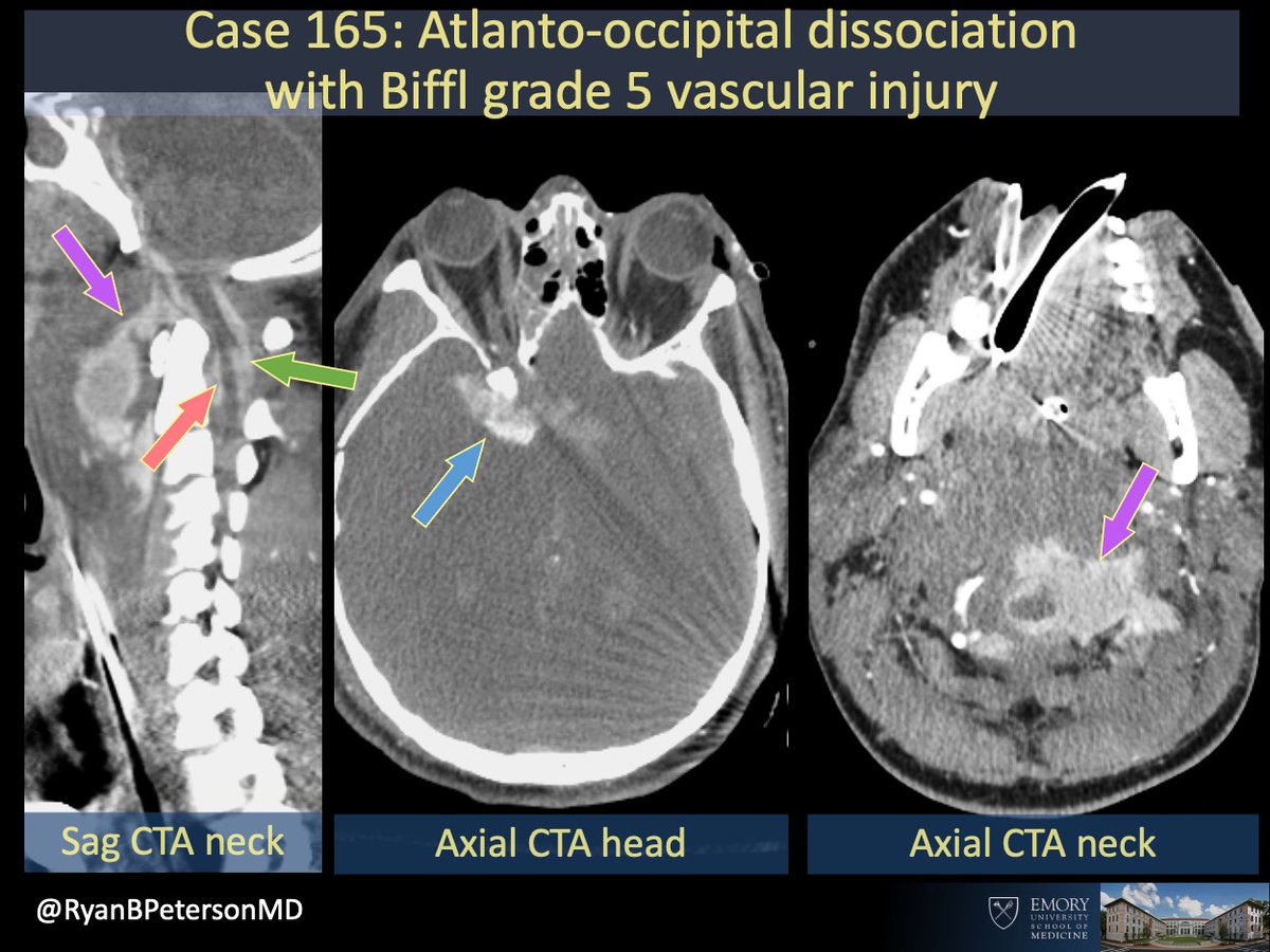 Emory Radiology COTD #165 Hx: Trauma NO SPOILERS!!! Give answers w ...