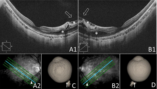 Posterior Staphyloma Oct