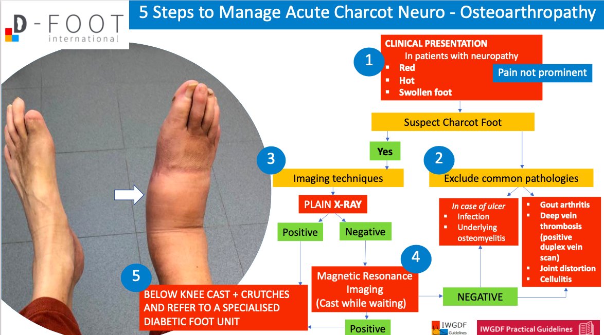 Acute Charcot Foot