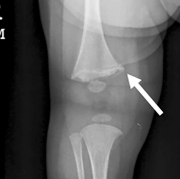Bucket Handle Fracture