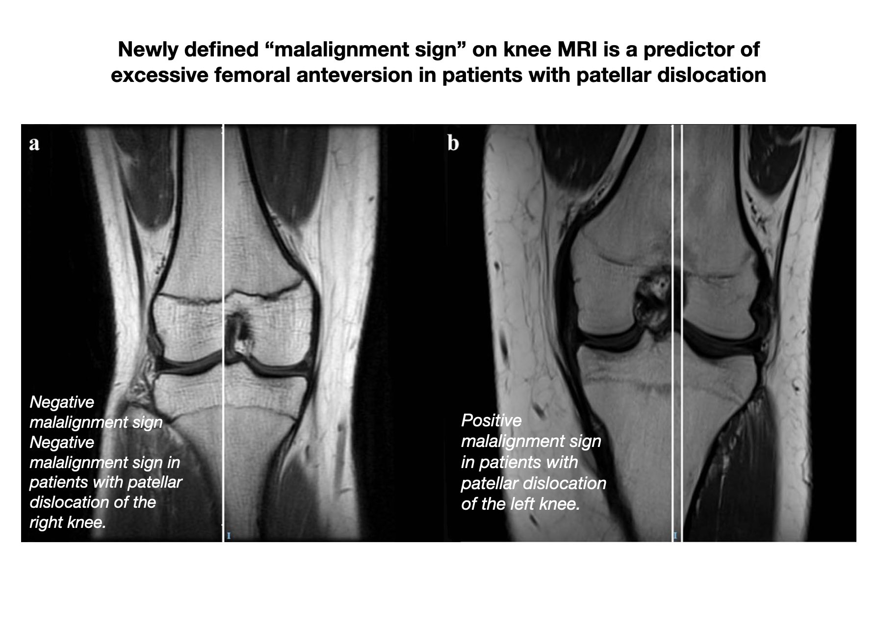 X Ray Femoral Anteversion