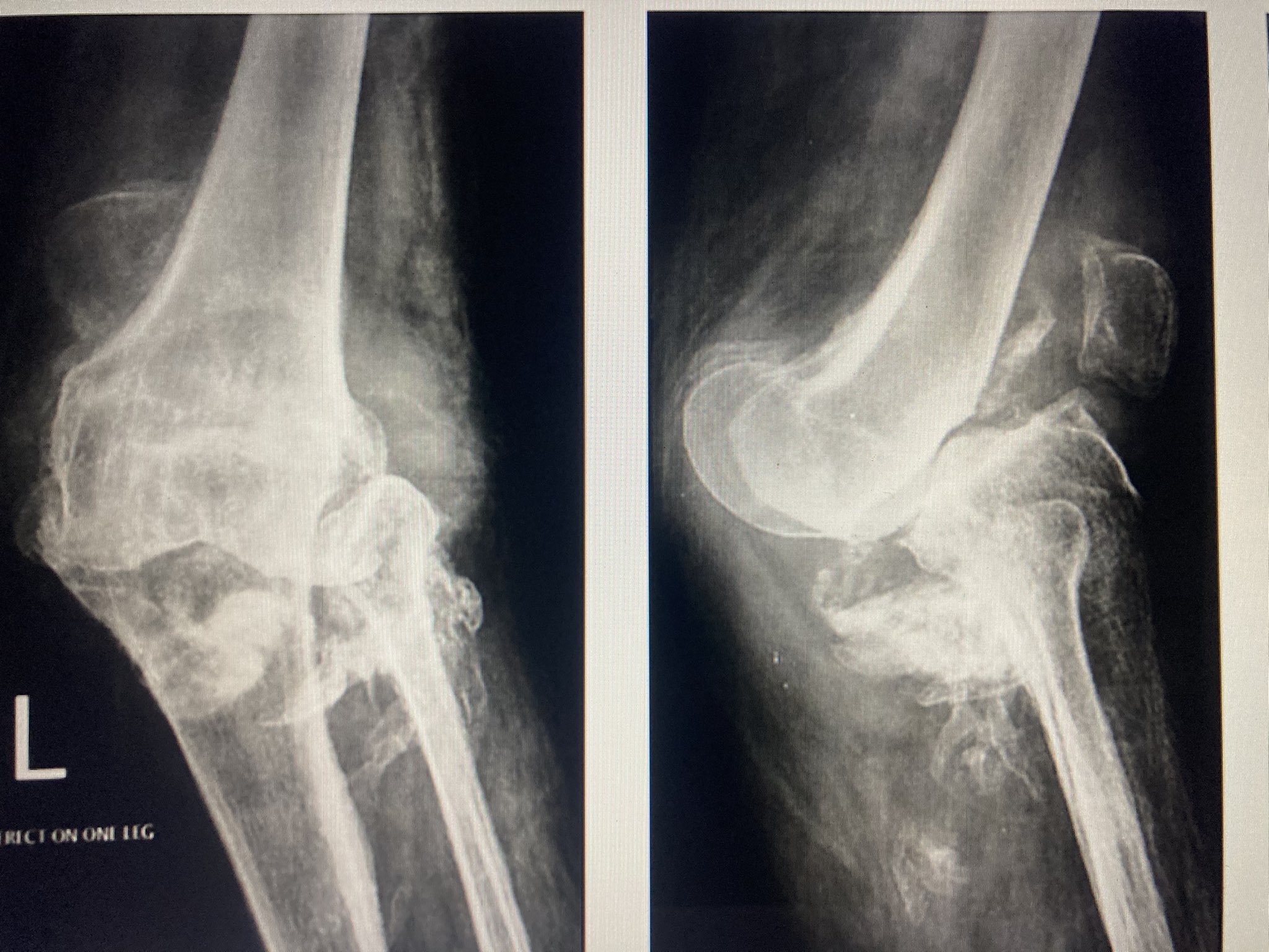 Greg Oden Injury Disasterplasty On X: "when My Elbow Hurts I Always