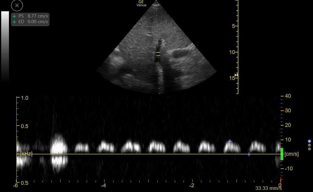 20 year old brought to the ED with altered mental status. Hypotension ...