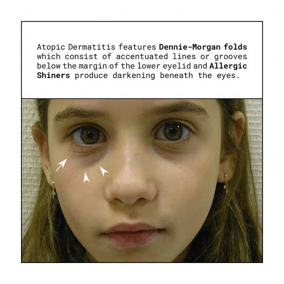 Dennie Lines Atopic Dermatitis