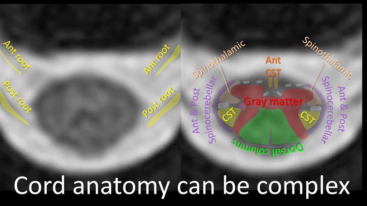 1/”I LOVE spinal cord syndromes!” is a phrase that has NEVER, EVER been ...