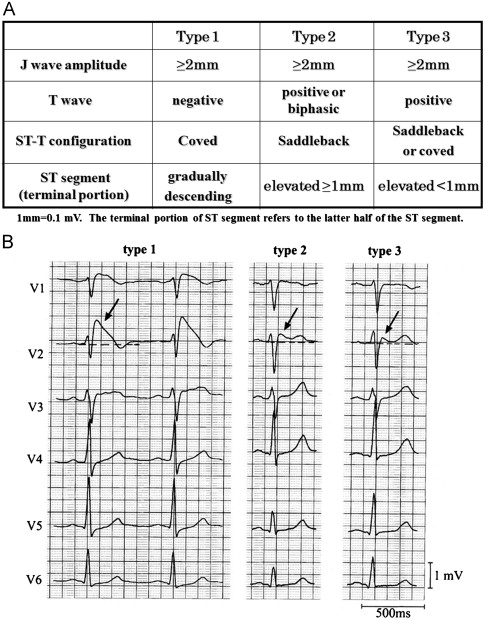 The BRUGADA family has contributed immensely to field of 🫀Cardiology ...