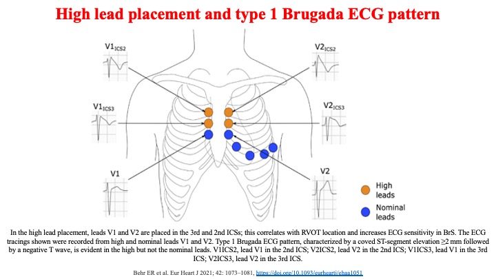 The BRUGADA family has contributed immensely to field of 🫀Cardiology ...