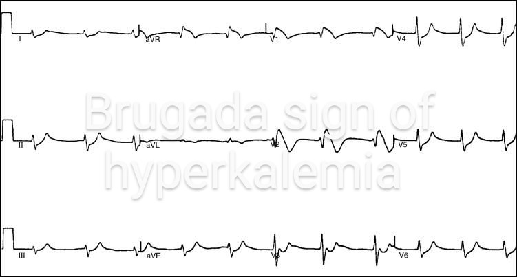 The BRUGADA family has contributed immensely to field of 🫀Cardiology ...