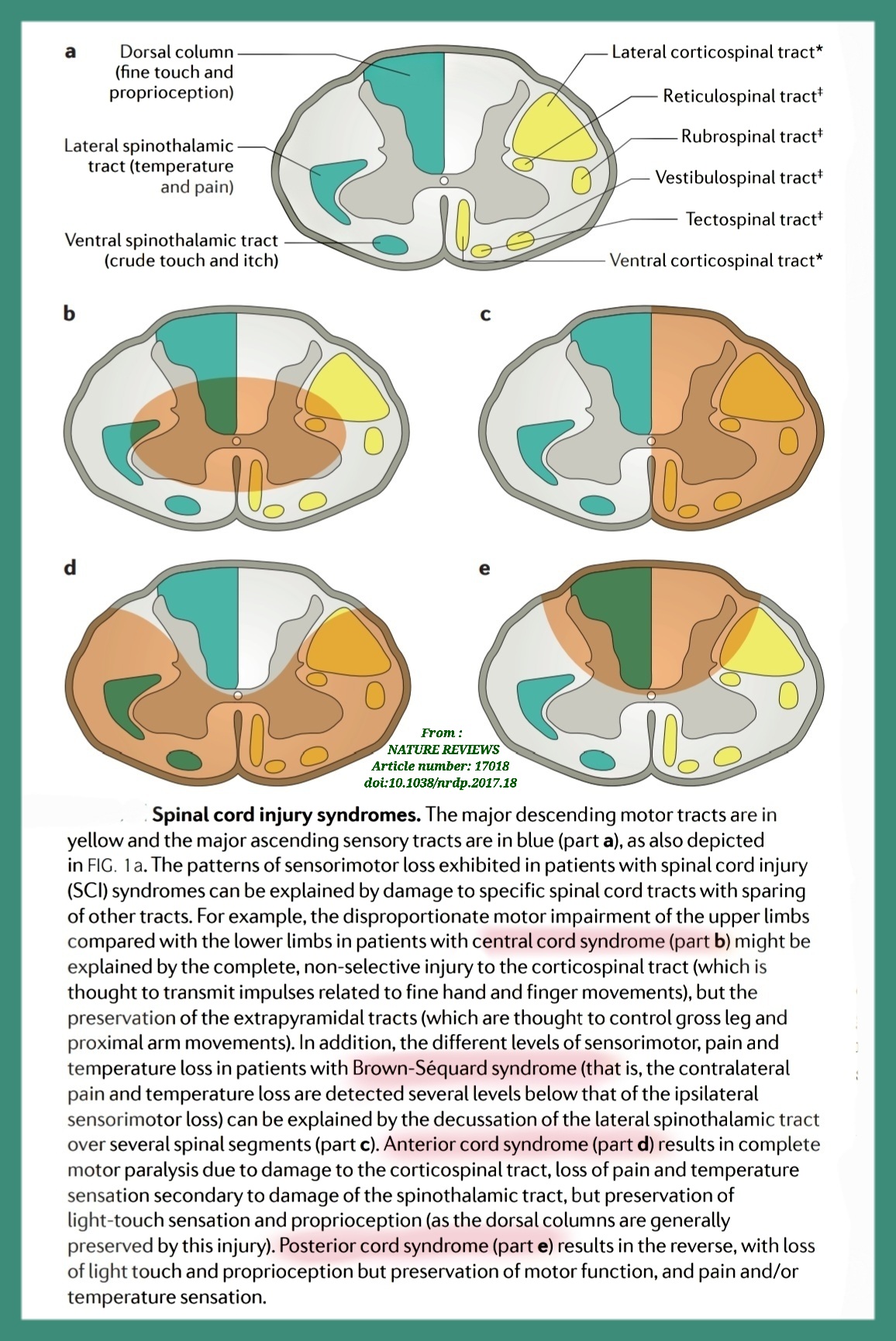 Anterior Cord Syndrome