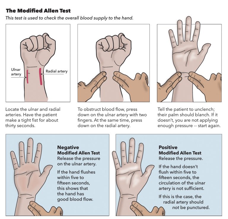 @docxusofficial Modified Allen test ️collateral blood flow 1 Pt ⬆️ hand ...