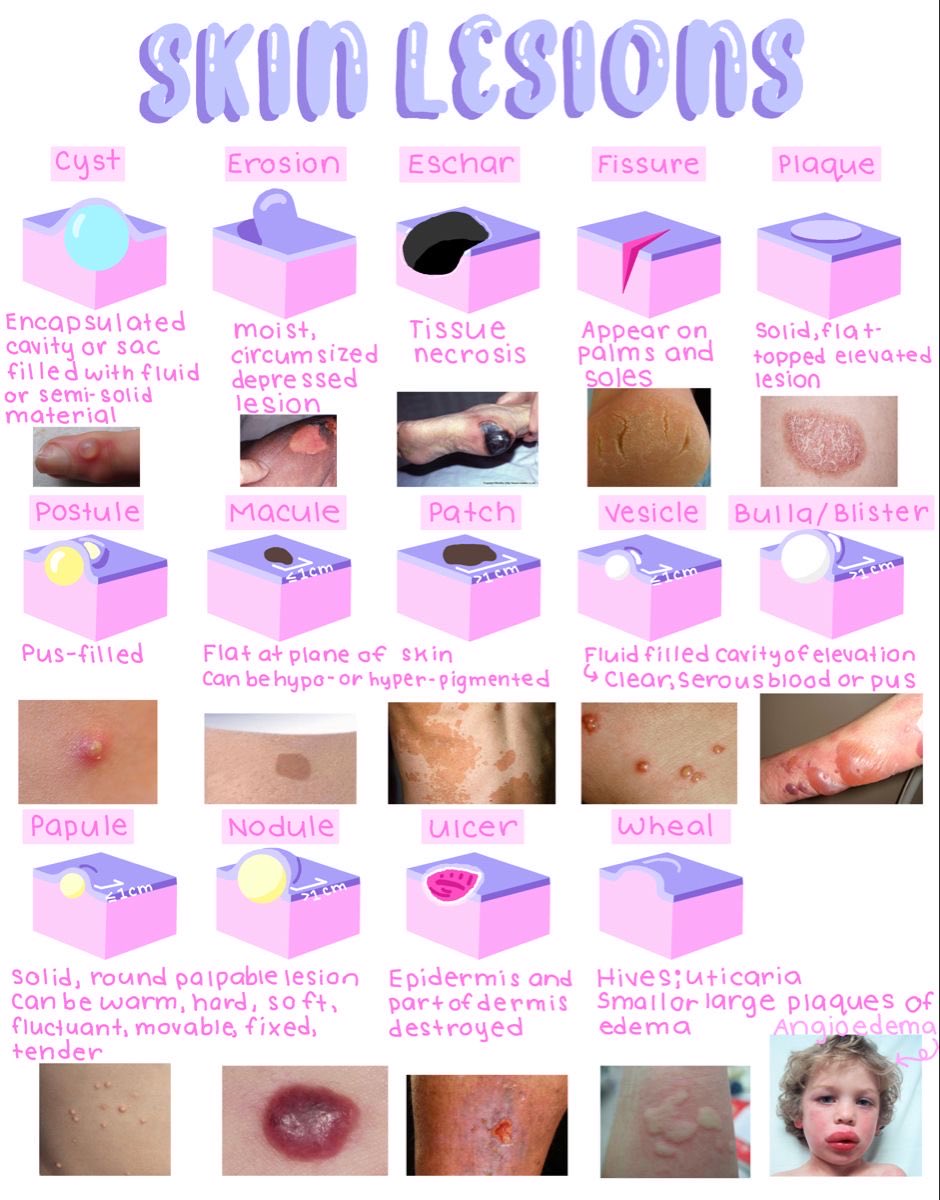 Skin Lesions Chart