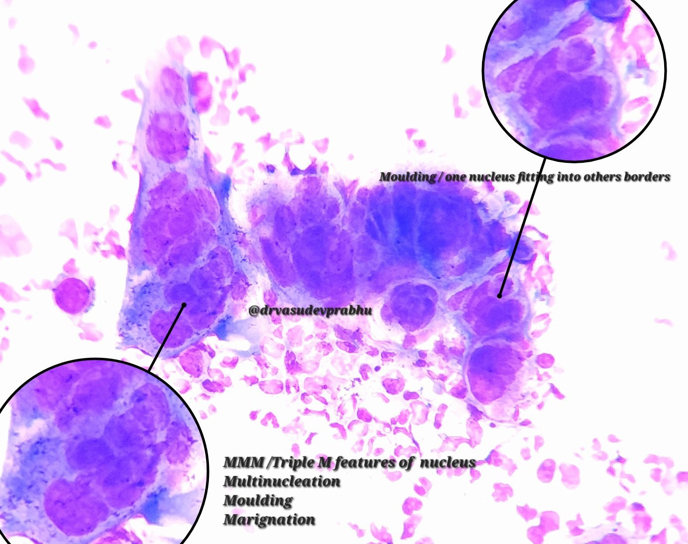 Tzanck Smear Varicella